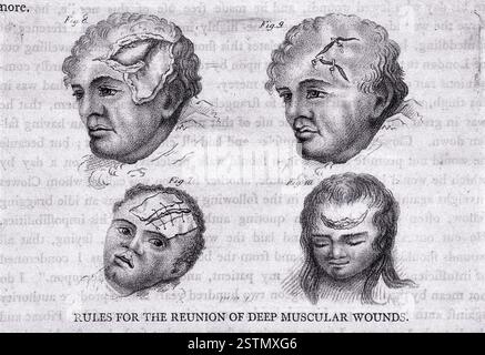 Four diagrams illustrating heads with severe wounds, demonstrating how ...