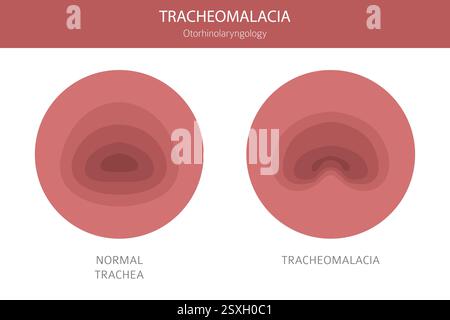 Tracheomalacia disease. Pulmonology, otolaryngology. Medical ...