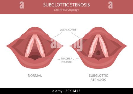 Subglottic Stenosis diseases. Pulmonology, otolaryngology. Medical ...
