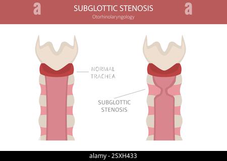 Subglottic Stenosis diseases. Pulmonology, otolaryngology. Medical ...