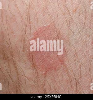 Close-up of red and flaky skin in the ear canal in a 59 year old male ...