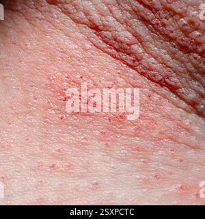 Human body wound. Skin irritation after shaving, pimples and acne and ...