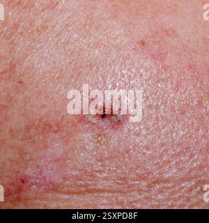 Solar keratosis or basalioma on human scalp Stock Photo - Alamy