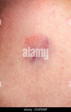 Bruise, hematoma on the human body. Large bruise, bruise on the stomach ...