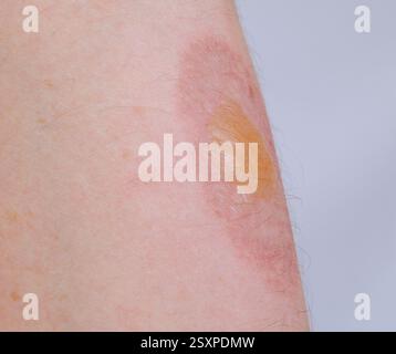 Treatment of burns on female hand on black background Stock Photo - Alamy