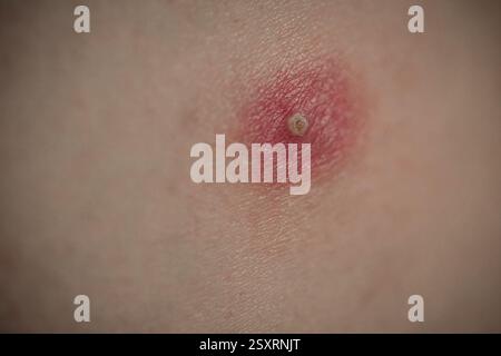 Infected and closed skin glands by staphylococcus. Bulge in skin due to ...