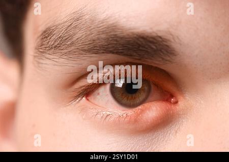 Conjunctivitis. Young man with infected eye, closeup Stock Photo - Alamy