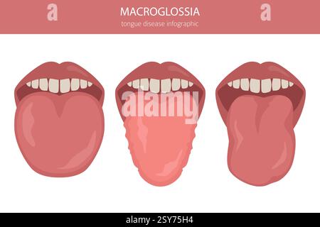 Macroglossia tongue disease. Oral medicine. Medical infographic design ...