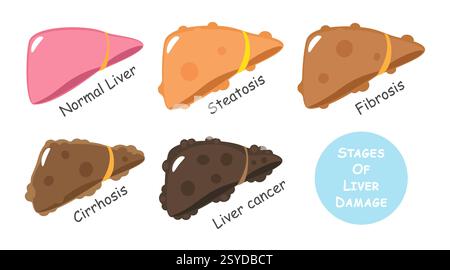 Liver damage infographic diagram cancer disease anatomy. Liver damage ...