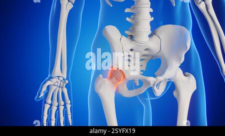 Male hip joint, illustration Stock Photo - Alamy