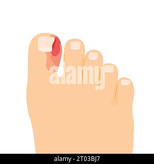 nail disease paronychia, inflammation of the skin around the nail ...