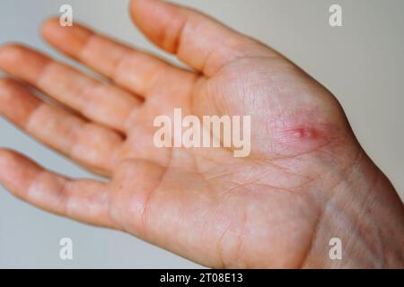 herpes on palm woman's hand Stock Photo - Alamy