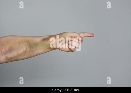 Car accident scar, pulmonary embolism treatment or domestic violence ...