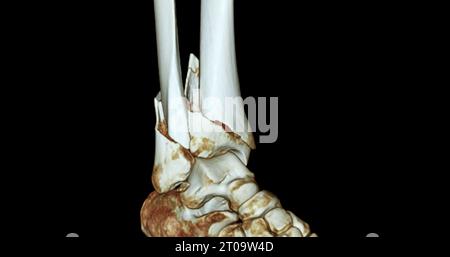 CT Scan ankle joint 3D Rendering image showing fracture tibia and ...
