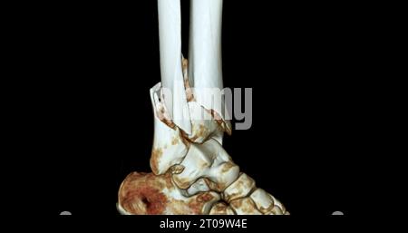 CT Scan ankle joint 3D Rendering image showing fracture tibia and ...