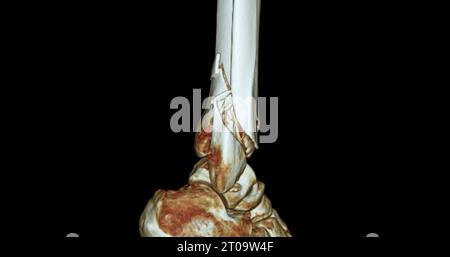 CT Scan ankle joint 3D Rendering image showing fracture tibia and ...