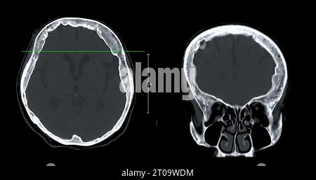 CT scan of the brain sagittal view for diagnosis brain tumor,stroke ...