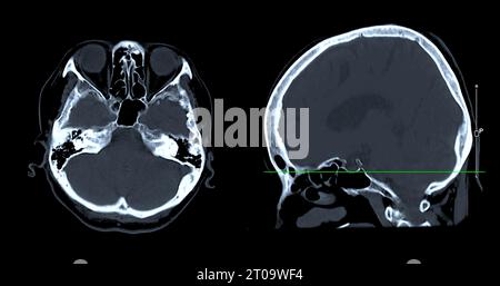 CT scan of the brain sagittal view for diagnosis brain tumor,stroke ...