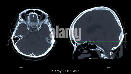 CT scan of the brain sagittal view for diagnosis brain tumor,stroke ...