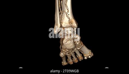 Foot 3D Scan for diagnosis foot diseases by CT-SCANNER Stock Photo - Alamy