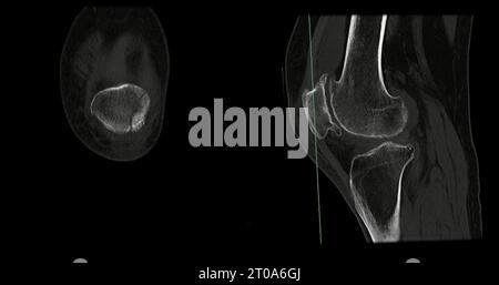 CT Scan of Knee joint sagittal and coronal in case fracture patella ...