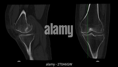 CT Scan of Knee joint sagittal and coronal in case fracture patella ...