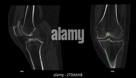 CT Scan of Knee joint sagittal and coronal in case fracture patella ...