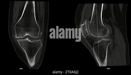 CT Scan of Knee joint sagittal and coronal in case fracture patella ...