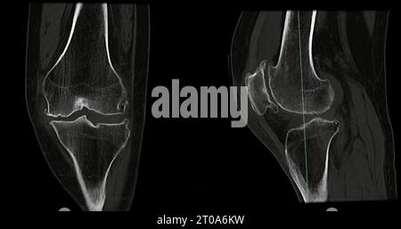 CT Scan of Knee joint sagittal and coronal in case fracture patella ...
