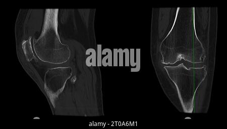 CT Scan of Knee joint sagittal and coronal in case fracture patella ...