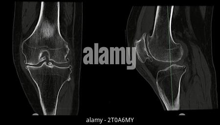 CT Scan of Knee joint sagittal and coronal in case fracture patella ...