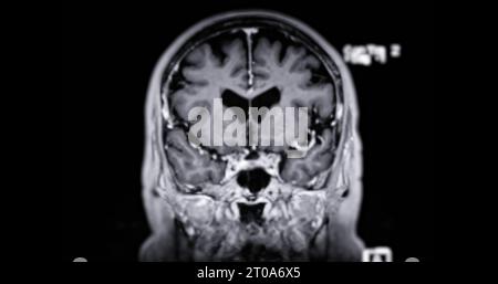 MRI scan of the brain for detect Brain diseases sush as stroke disease ...