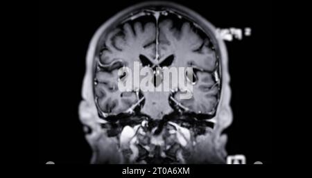 MRI scan of the brain for detect Brain diseases sush as stroke disease ...