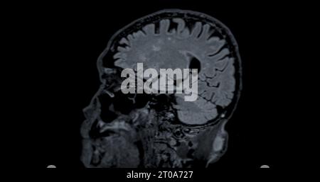 MRI scan of the brain for detect Brain diseases sush as stroke disease ...