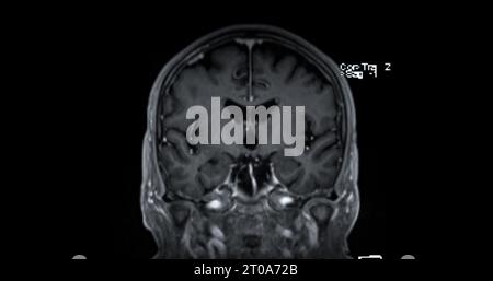 MRI scan of the brain for detect Brain diseases sush as stroke disease ...