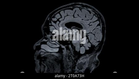 MRI scan of the brain for detect Brain diseases sush as stroke disease ...
