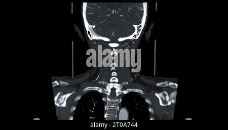 CTA BRAIN or CT angiography of the brain 3D Rendering image AP and ...