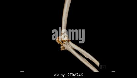 CT scan of elbow joint 3d rendering Stock Photo - Alamy