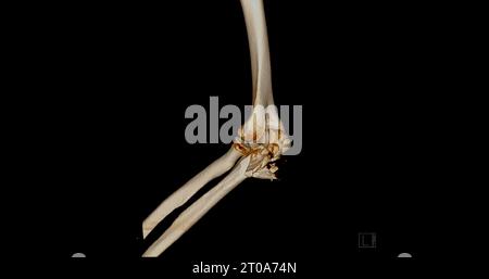CT scan of elbow joint 3d rendering Stock Photo - Alamy