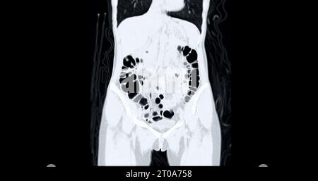 CT Colonoscopy coronal view .Medical background Stock Photo - Alamy