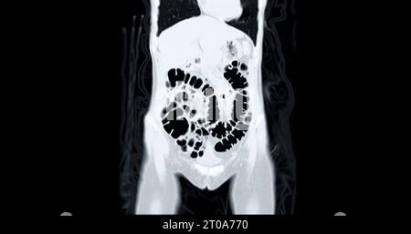 CT Colonoscopy coronal view .Medical background Stock Photo - Alamy