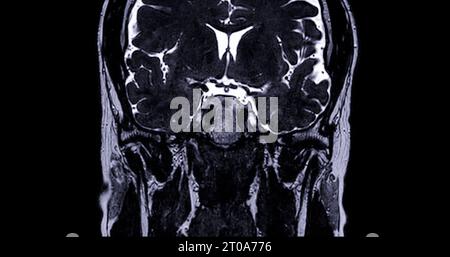 MRI scan of the internal auditory canal (IAC Stock Photo - Alamy