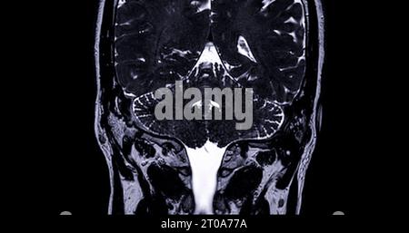 MRI scan of the internal auditory canal (IAC Stock Photo - Alamy
