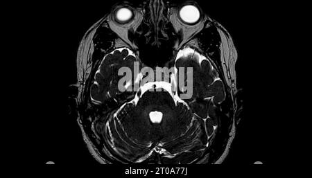 MRI scan of the internal auditory canal (IAC Stock Photo - Alamy