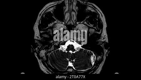 MRI scan of the internal auditory canal (IAC Stock Photo - Alamy