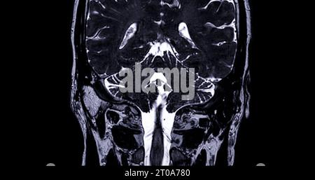 MRI scan of the internal auditory canal (IAC Stock Photo - Alamy
