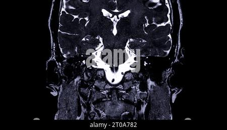 MRI scan of the internal auditory canal (IAC Stock Photo - Alamy
