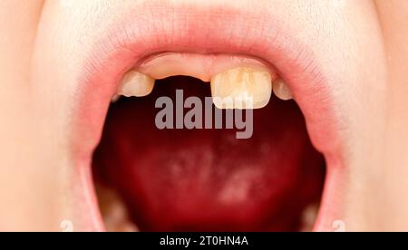 Child smile and show her crowding tooth. Close up of unhealthy baby ...