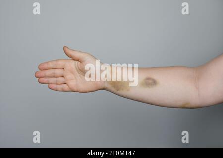 Large bruise on human arm. Injection bruises. Doctor and patient indoor ...
