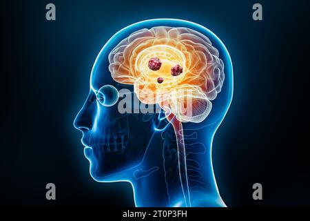 Human brain cancer with cancerous cells or tumors x-ray 3D rendering ...